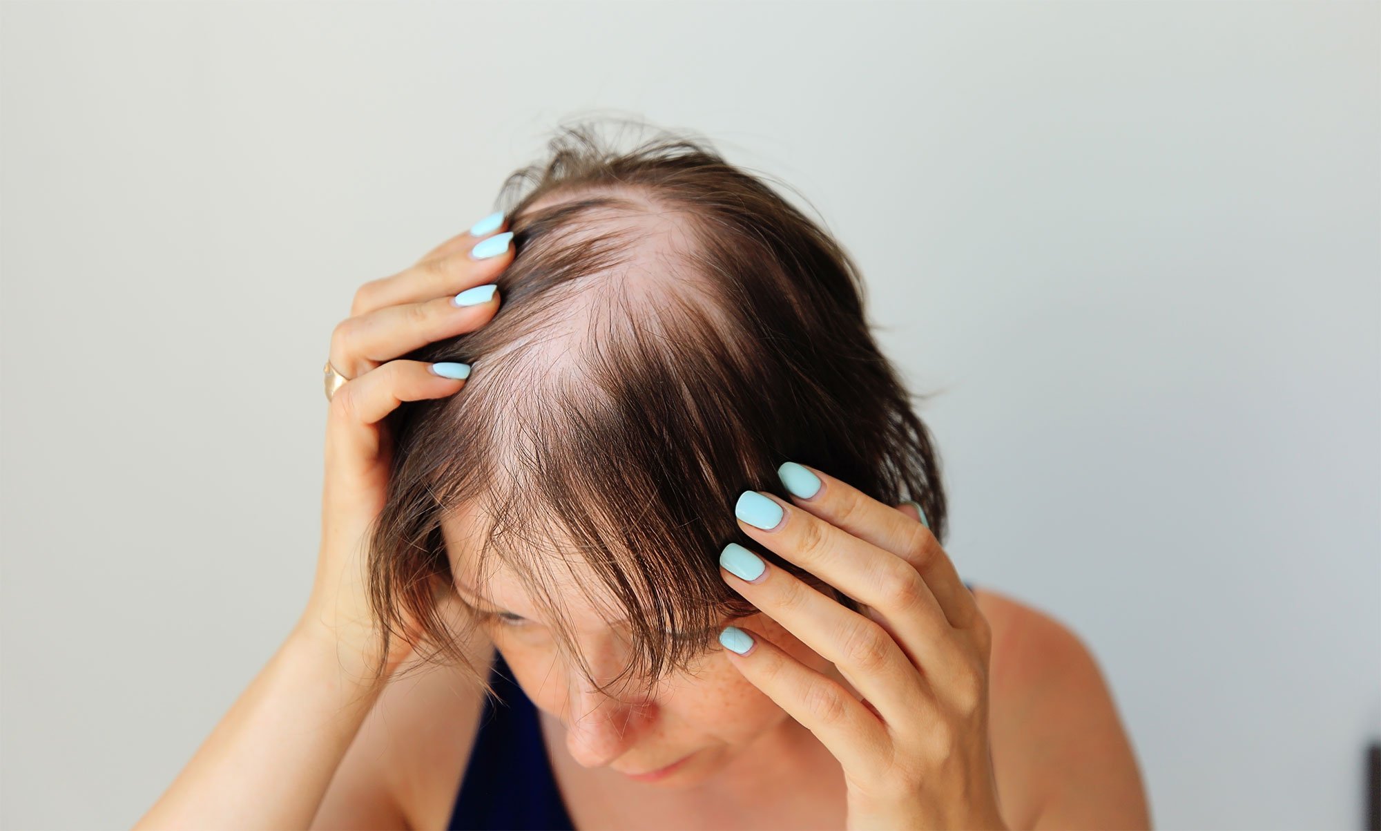 Central Centrifugal Cicatricial Alopecia Treatment: A Comprehensive ...