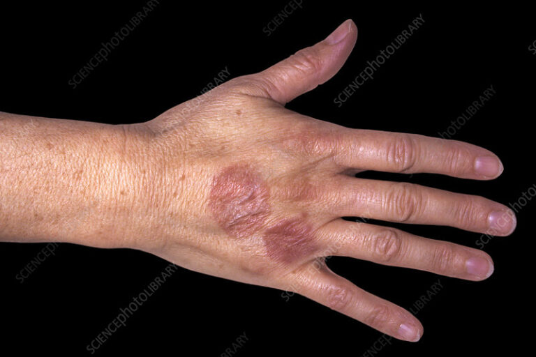 Skin Health – Granuloma Annulare, Acne, Sun Protection, Anti-aging ...