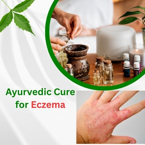 Ayurvedic Cure for Eczema: Natural Solutions for Lasting Relief ...